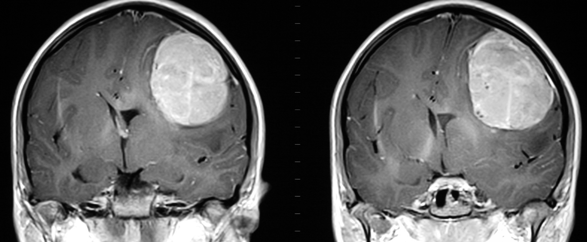 Brain tumours treatment and rehabilitation in Germany